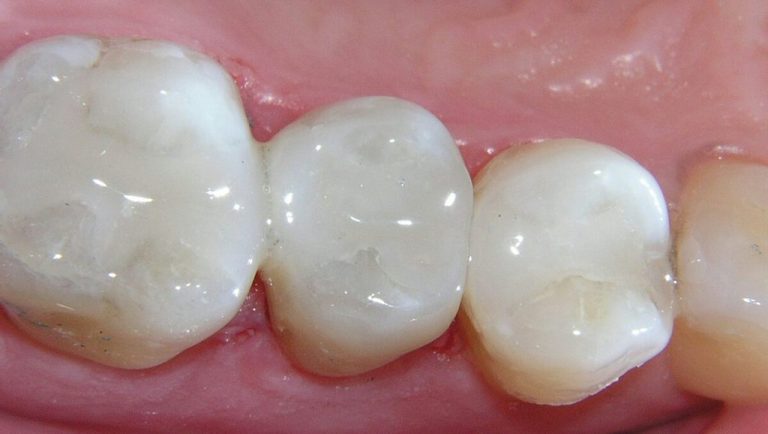 Bele plombe – In Dental Stomatologija & Estetika | Stomatolog Novi Sad ...